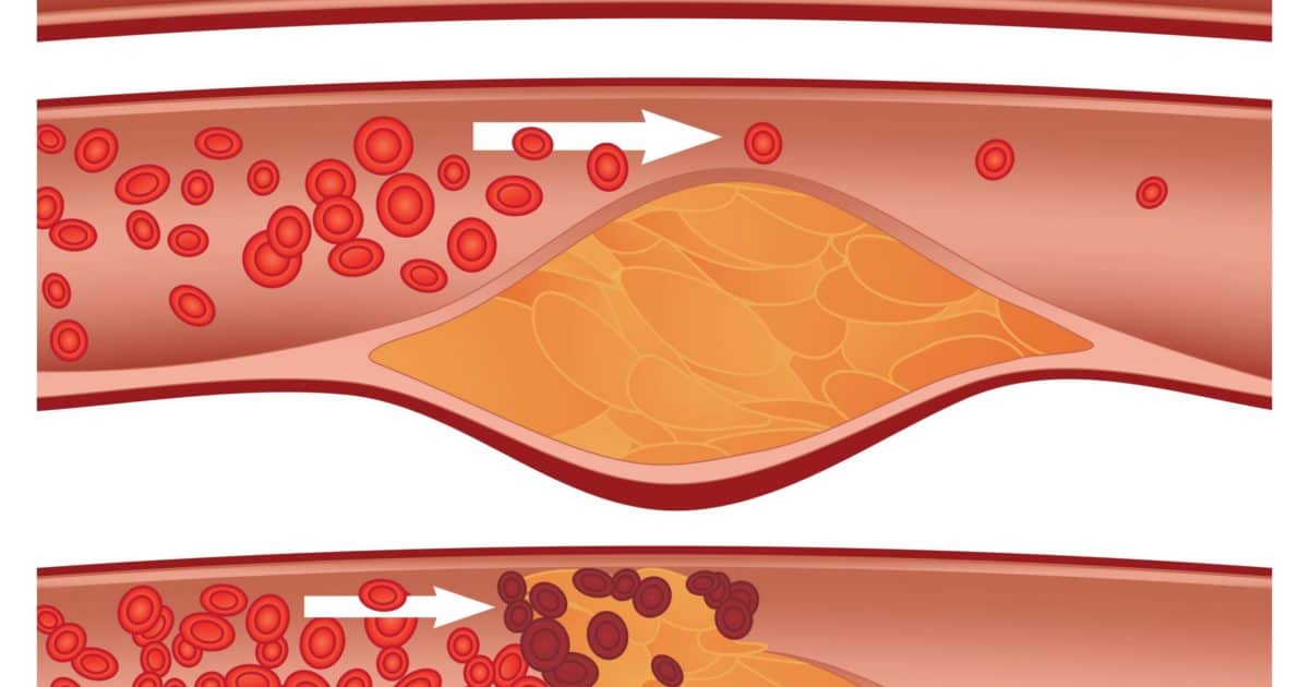 Os perigos do colesterol elevado - Amato