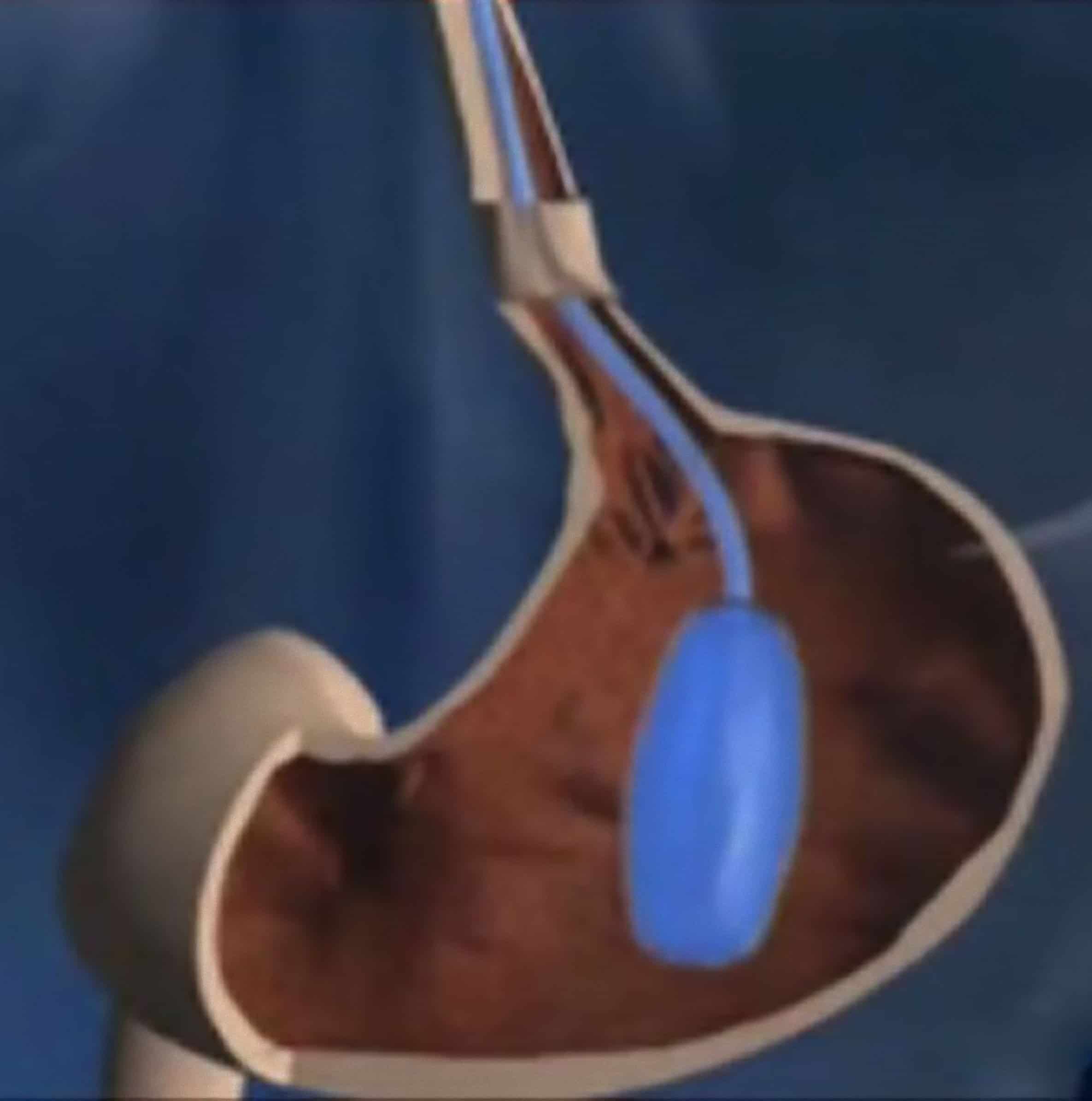 Balão intragástrico: recurso para perder peso - Amato