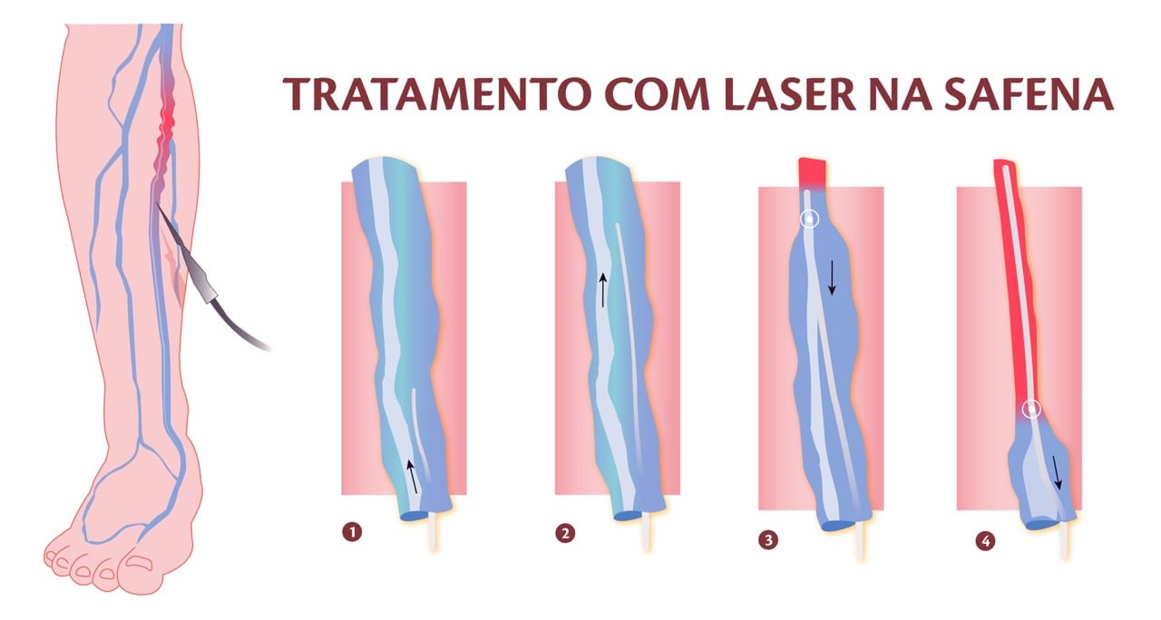 Cirurgia de Varizes com Laser - Amato