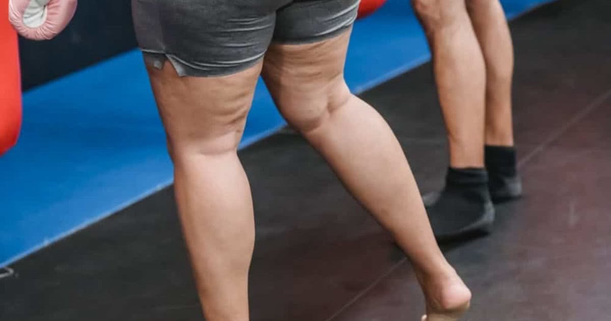 Qual tratamento para o lipedema? - Amato