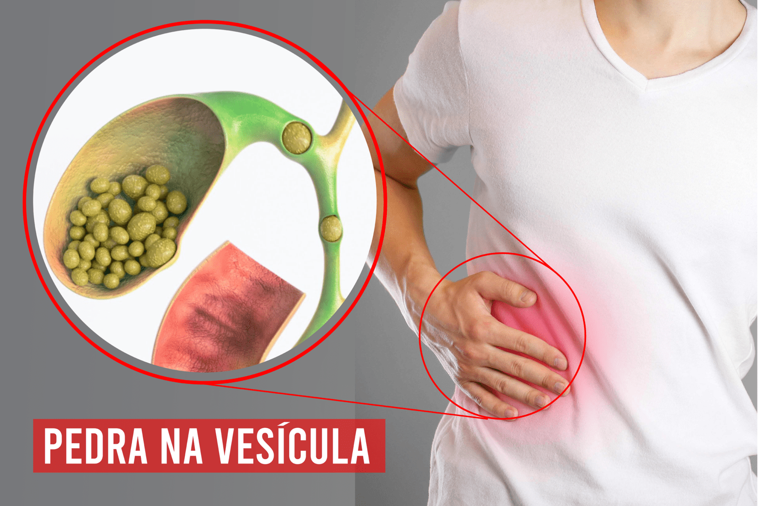 Cirurgia de vesícula com alta no mesmo dia: tudo o que você precisa saber