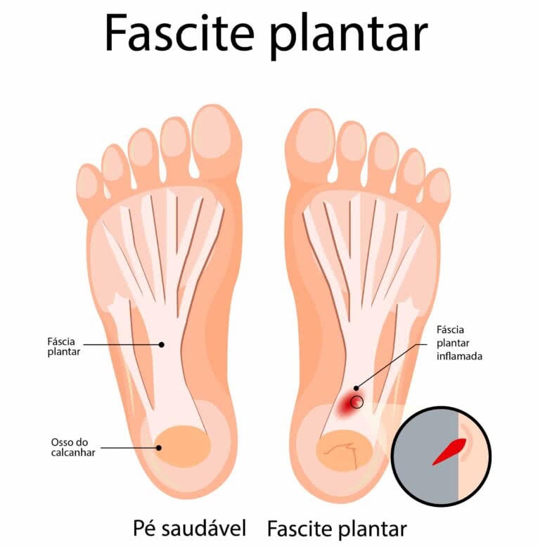Sintomas da fascite plantar: como identificar - Amato