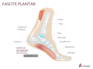 Sintomas da fascite plantar: como identificar - Amato