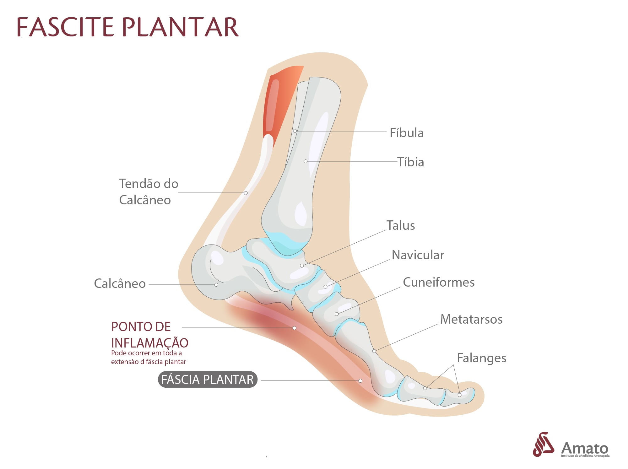 Sintomas da fascite plantar: como identificar - Amato