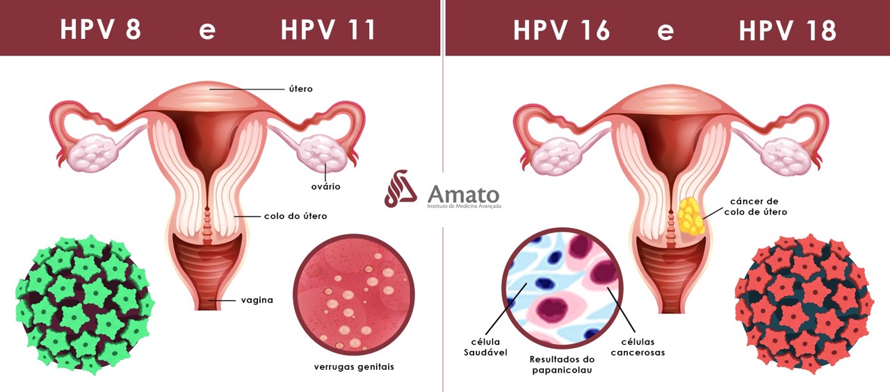 HPV: O que é, como prevenir e tratar - Amato