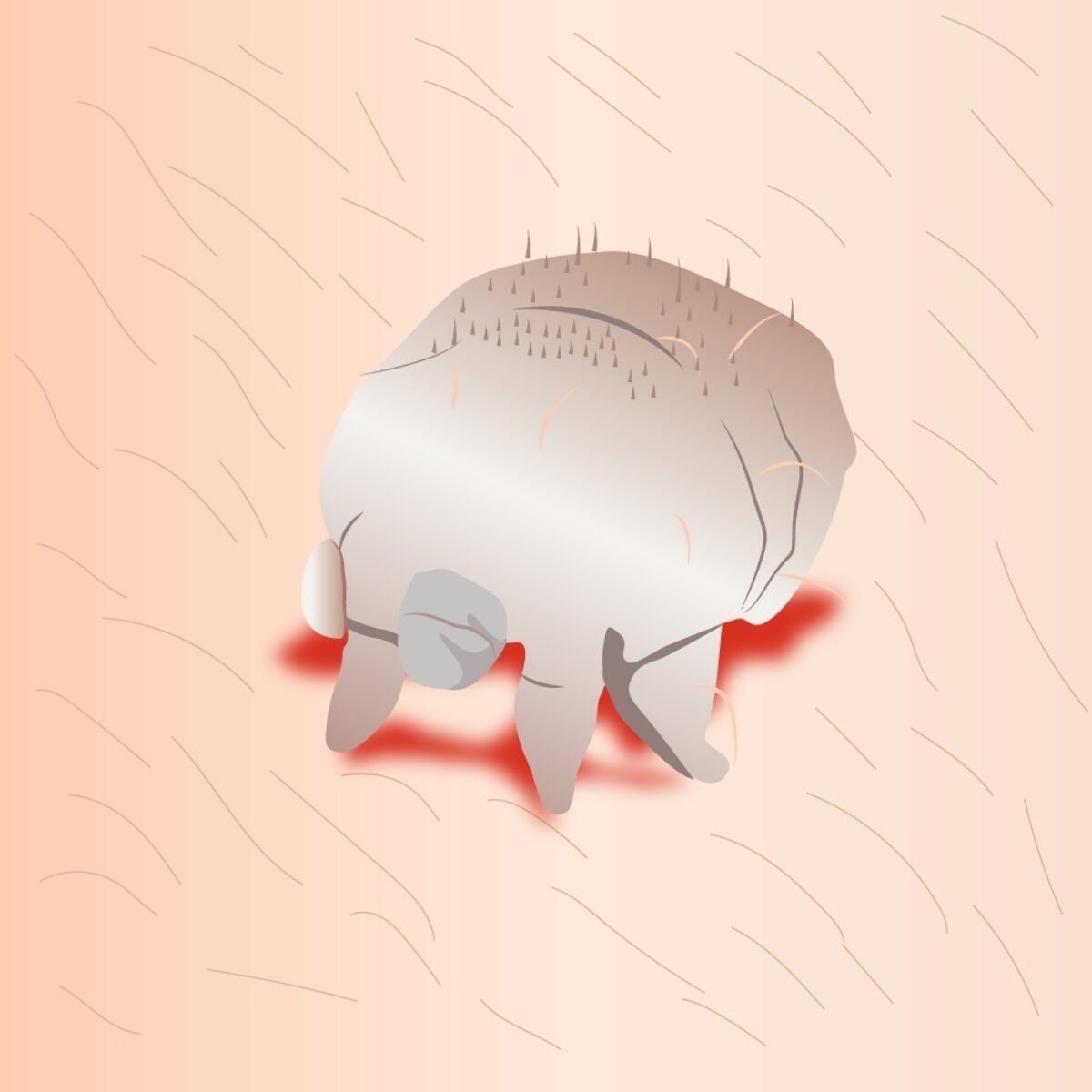 Escabiose ou sarna. Doença parasitária. - Amato